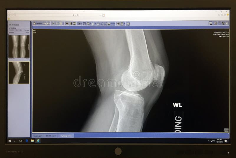 X-Ray of a Healthy Knee Bone on a Computer Screen Stock Photo - Image ...