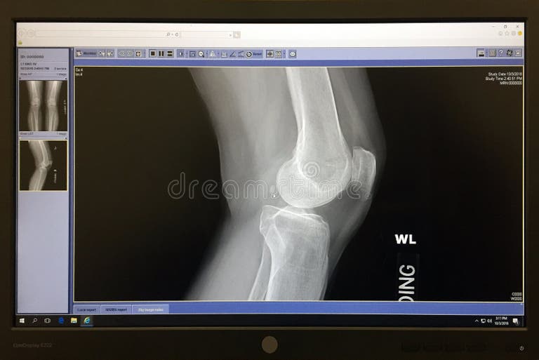 X-Ray of a Healthy Knee Bone on a Computer Screen Stock Photo - Image ...