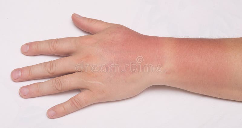 Sunburn stock image. Image of lines, roasted, medical, clipping - 818347