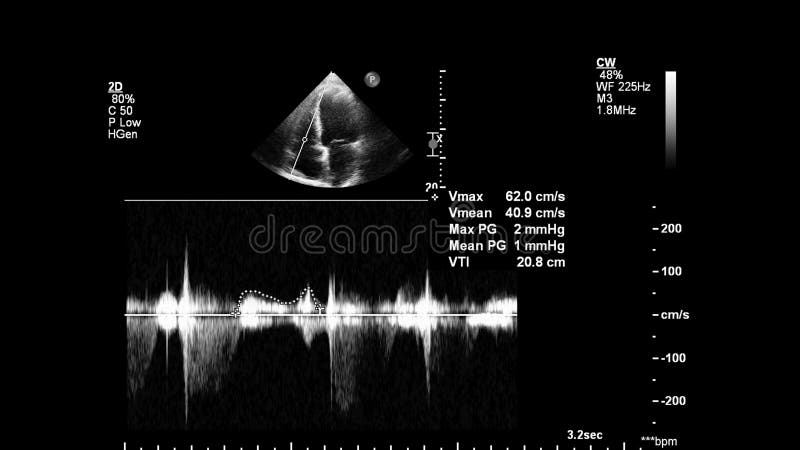 120 Heart Failure Ultrasound Stock Photos - Free & Royalty-Free Stock ...