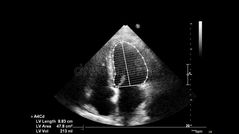 128 Heart Failure Ultrasound Stock Photos - Free & Royalty-Free Stock ...
