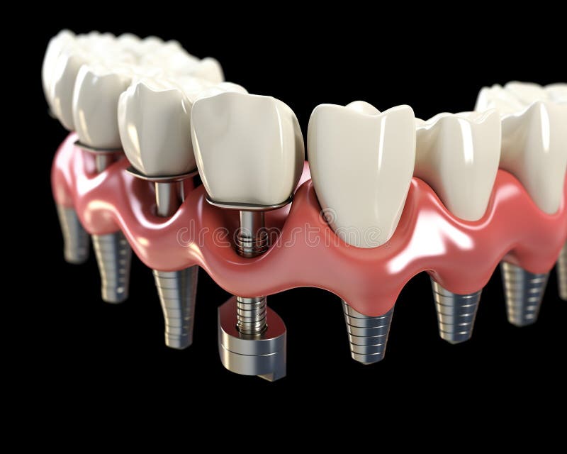 The Lower Jaw Has a Dental Post and Core Tooth Restoration. Stock ...