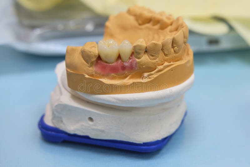 Set of the false teeth stock image. Image of denture - 130491323