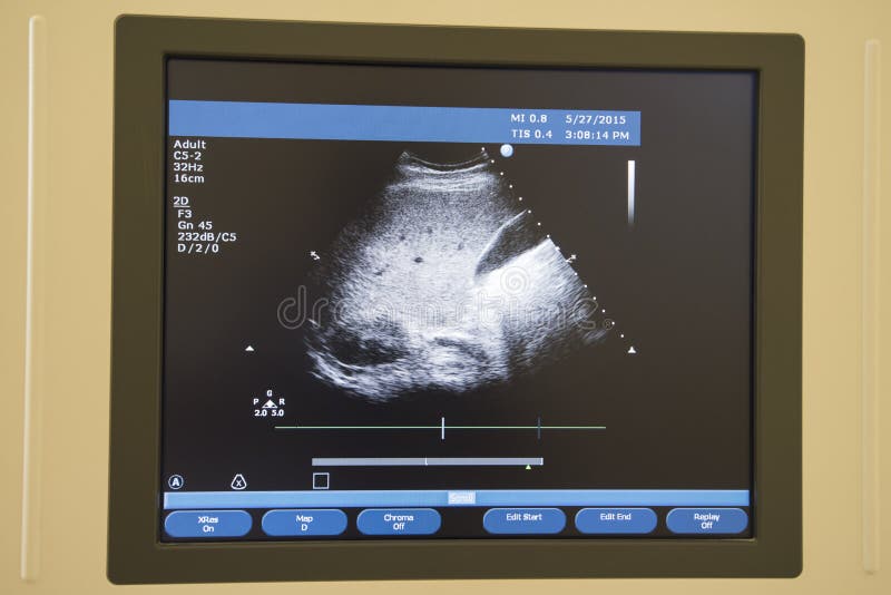 Image on an Ultrasound Scanner Stock Image - Image of health, doctor ...