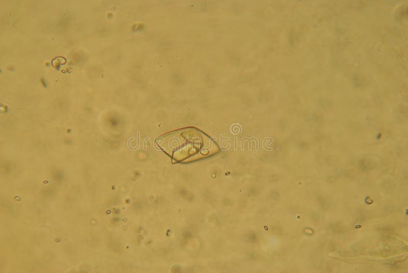 Image of Urine Under Microscope Stock Image - Image of details, crystal ...