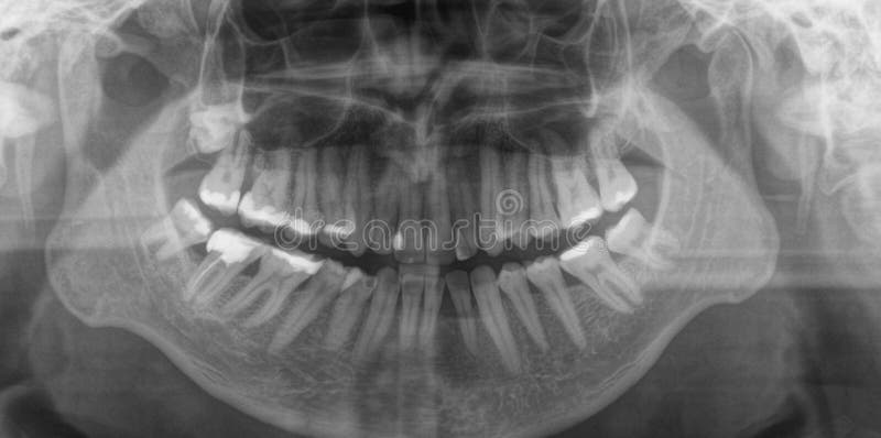 Imagem De Raio X Do Maxilar Foto de Stock - Imagem de radiologia ...