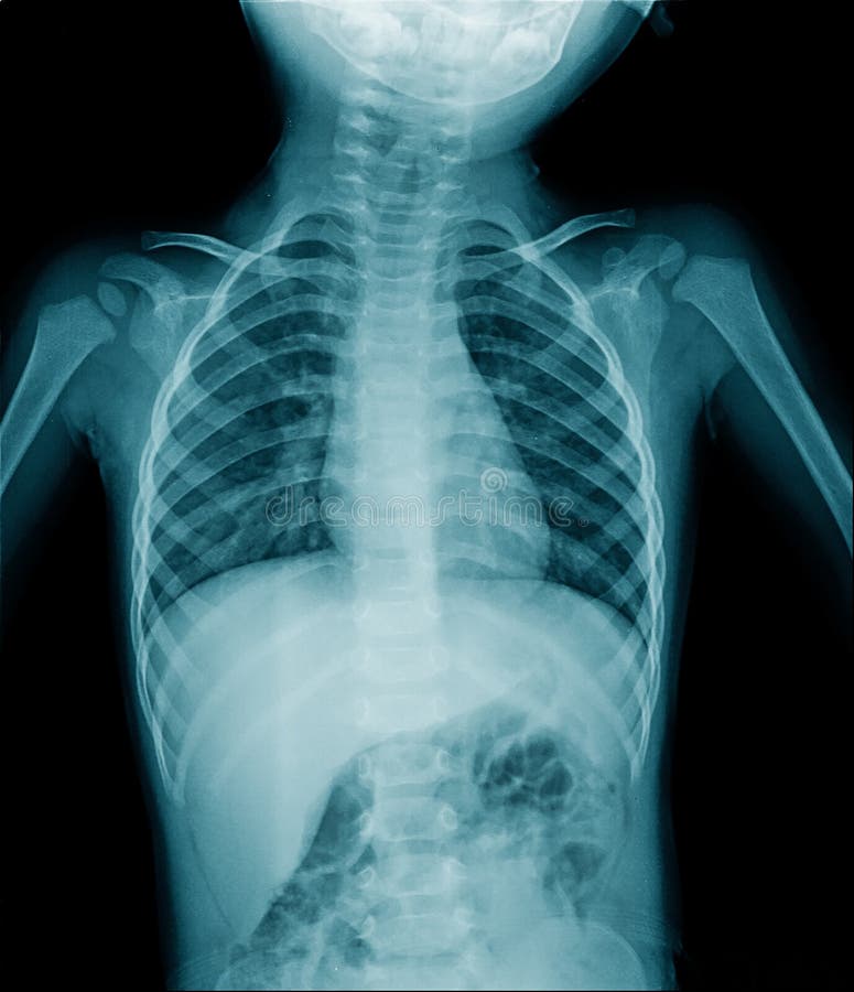 Imagem De Raio-x Do Tórax Do Bebê Imagem de Stock - Imagem de preto ...