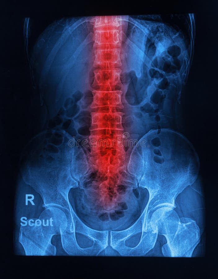 Imagem Do Raio X Da Coluna Espinal Foto de Stock - Imagem de doutor ...