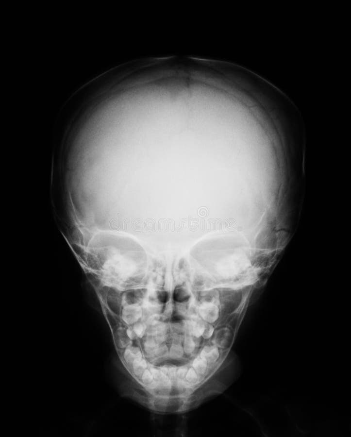 Imagem Do Raio X Do Crânio Do Bebê Vista Lateral Imagem de Stock ...