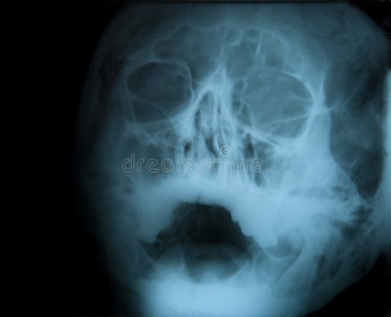 Sinusitis maxilar aguda foto de archivo. Imagen de maxilar - 115414860
