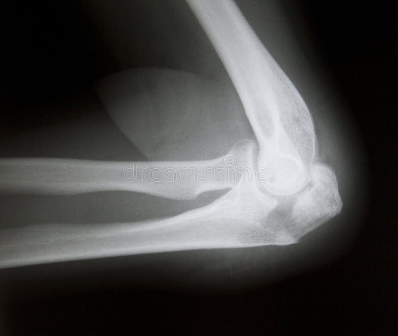 Imagen Quebrada De La Radiografía Del Codo Imagen de archivo - Imagen ...