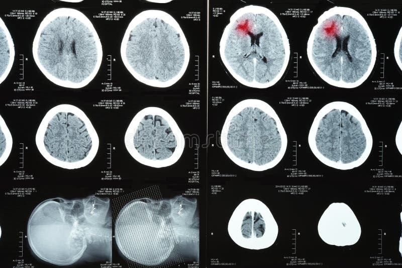 Images from a Computerized Tomography Stock Image - Image of head ...