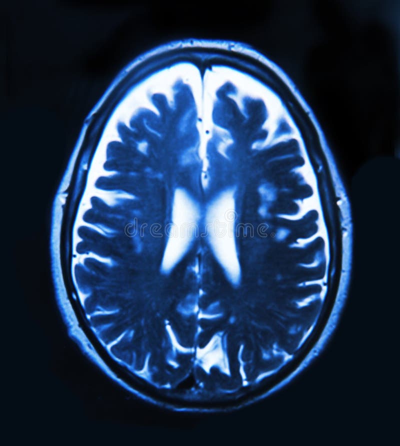 Brain MRI Scan Mouse Wheel stock image. Image of dementia - 14815303