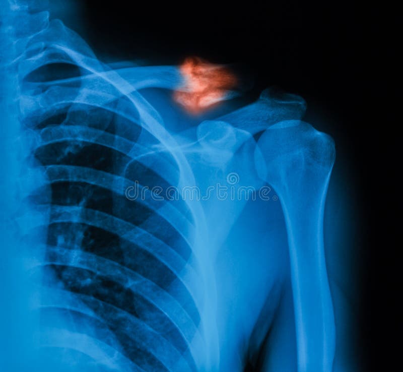 Immagine Dei Raggi X Della Clavicola Rotta Immagine Stock - Immagine di ...