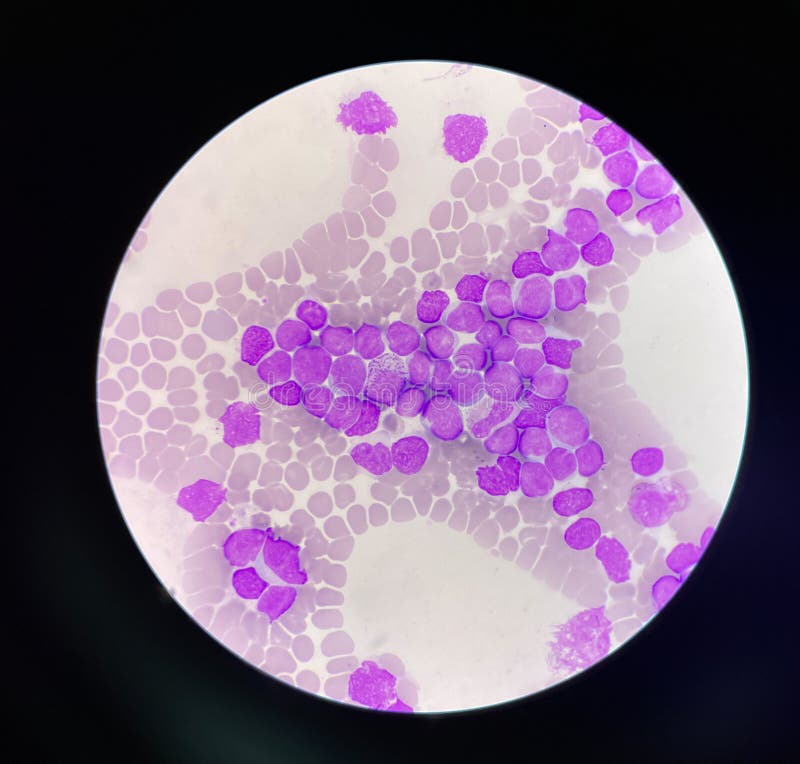 Immatture Wbc Acute Lyphoblastic Leukemia Stock Image - Image of ...