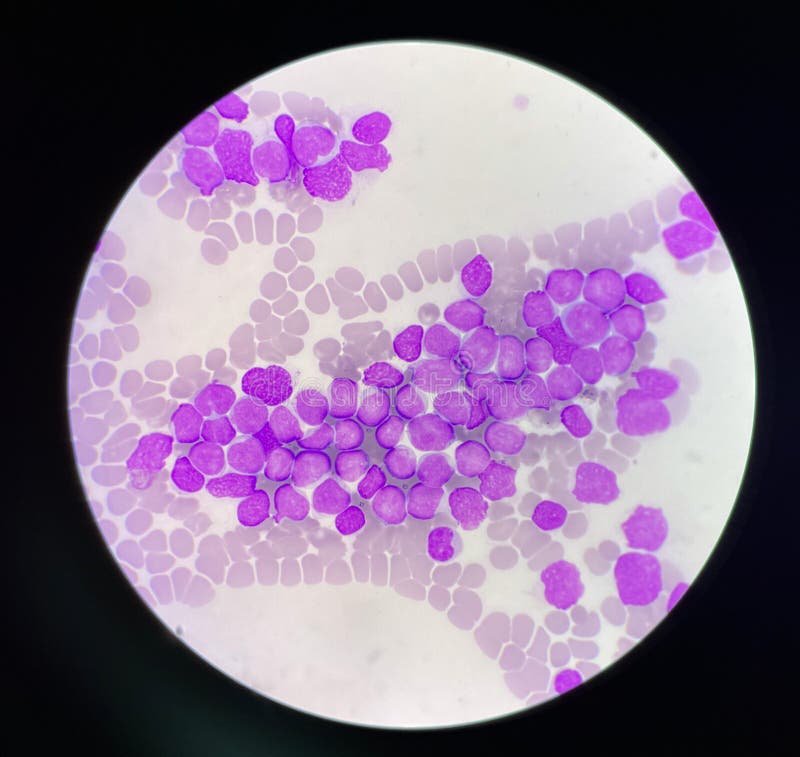 Immatture Wbc Acute Lyphoblastic Leukemia Stock Photo - Image of ...