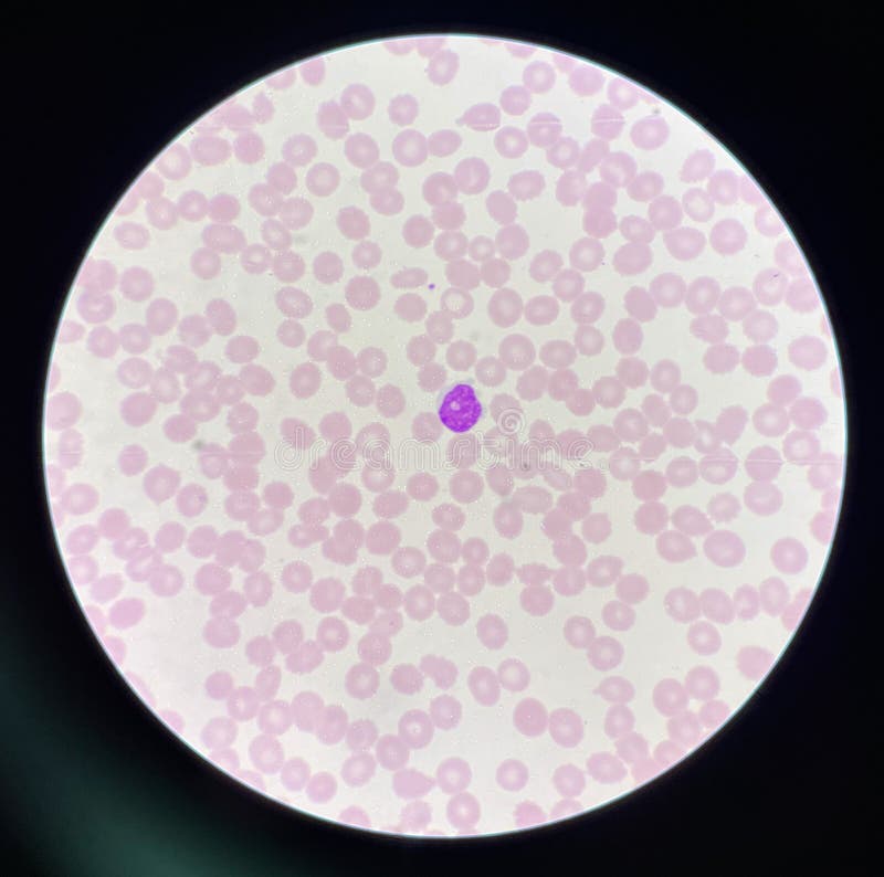 Immature Wbc on Rbc Background Stock Image - Image of glandular ...