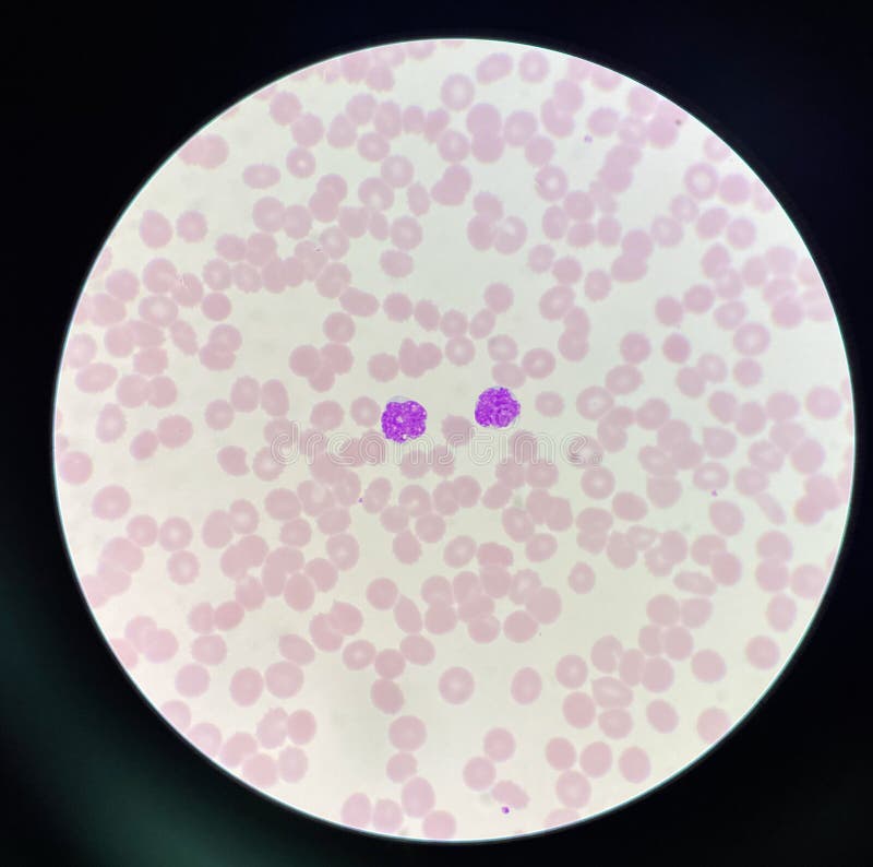 Immature Wbc on Rbc Background Stock Image - Image of lymphocytes ...