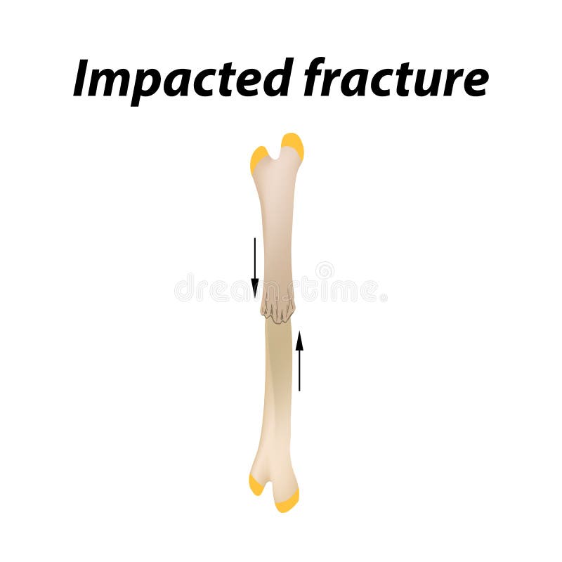 Transverse Bone Fracture. Infographics. Vector Illustration on a Lined ...