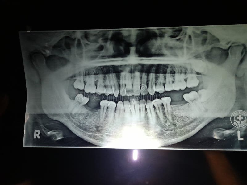 Impacted Teeth Panoramic X-ray Editorial Stock Photo - Image of white ...