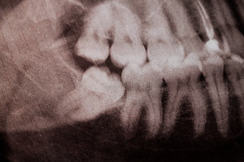 Impacted Wisdom Tooth on the Lower Jaw X-ray Image, Close-up Stock ...