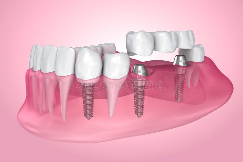 Implant Supported Fixed Bridge. Stock Illustration - Illustration of ...