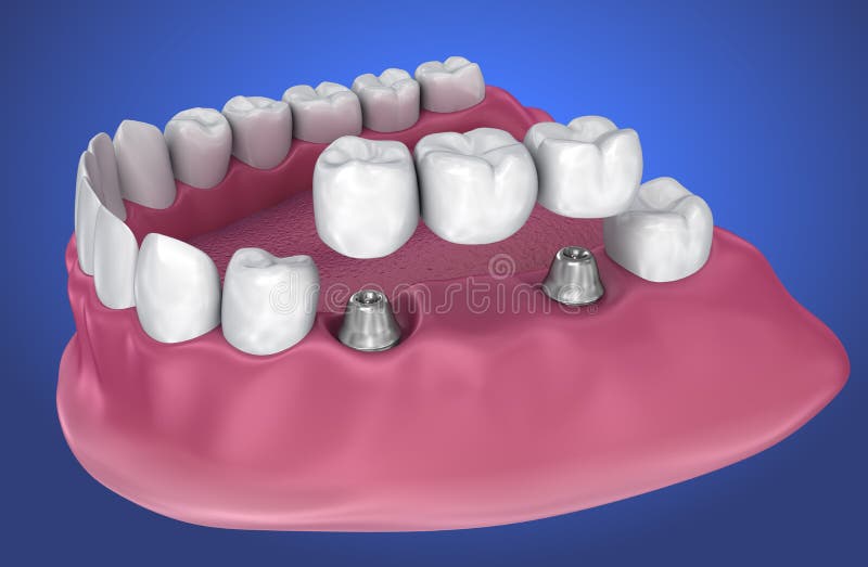 Implant Supported Fixed Bridge. Medically Accurate Stock Illustration ...