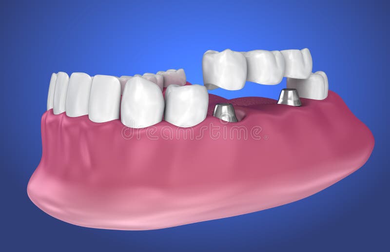 Implant Supported Fixed Bridge. Stock Illustration - Illustration of ...