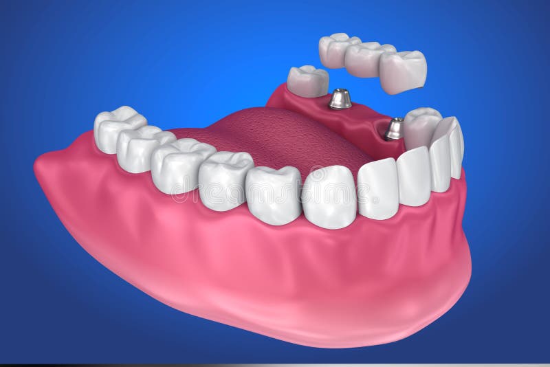 Implant Supported Fixed Bridge. Stock Illustration - Illustration of ...