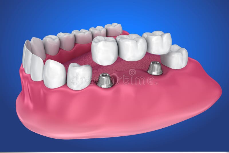 Implant Supported Fixed Bridge. Medically Accurate Stock Illustration ...