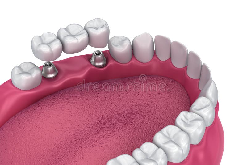 Implant Supported Fixed Bridge. Stock Illustration - Illustration of ...