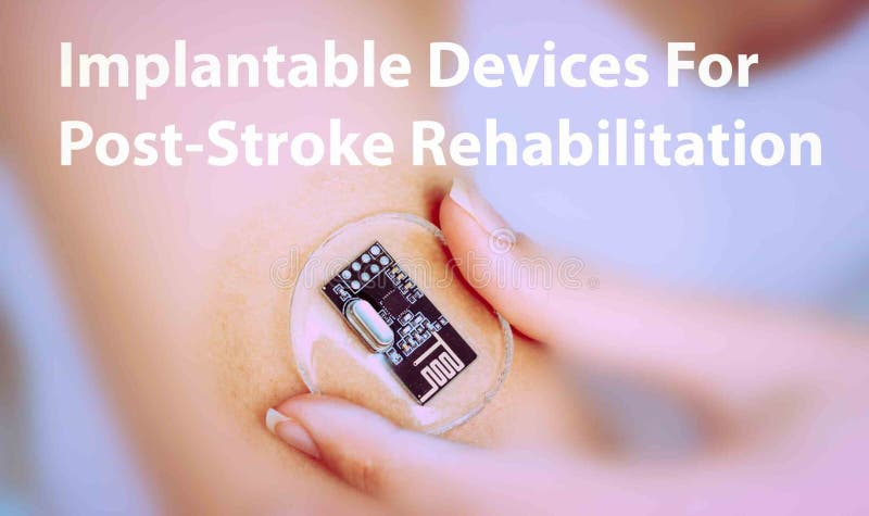 Neuromodulation Devices Stock Photos - Free & Royalty-Free Stock Photos ...