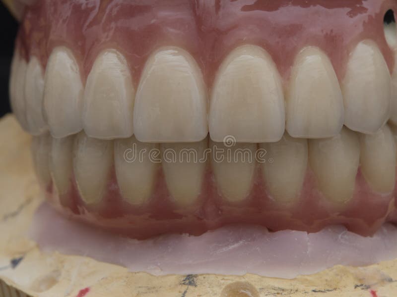 Implante imagen de archivo. Imagen de medicina, lower - 106846197