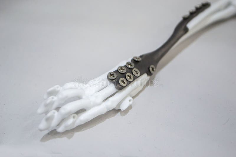 Implants and Prostheses Printed on 3D Printer from Biocompatible ...