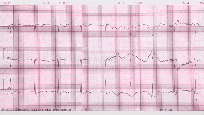 ECG normal photo stock. Image du médical, électrocardiographe - 1842238