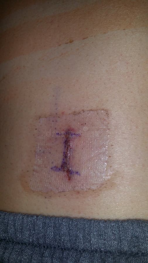 Incision L5 Surgery spine stock image. Image of incision - 144766613