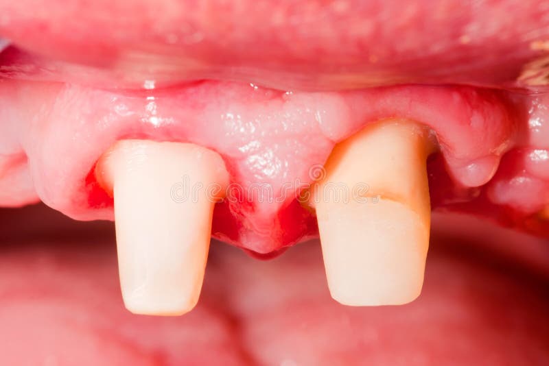 Incisive Tooth Restoration Treatment Stock Photos - Free & Royalty-Free ...