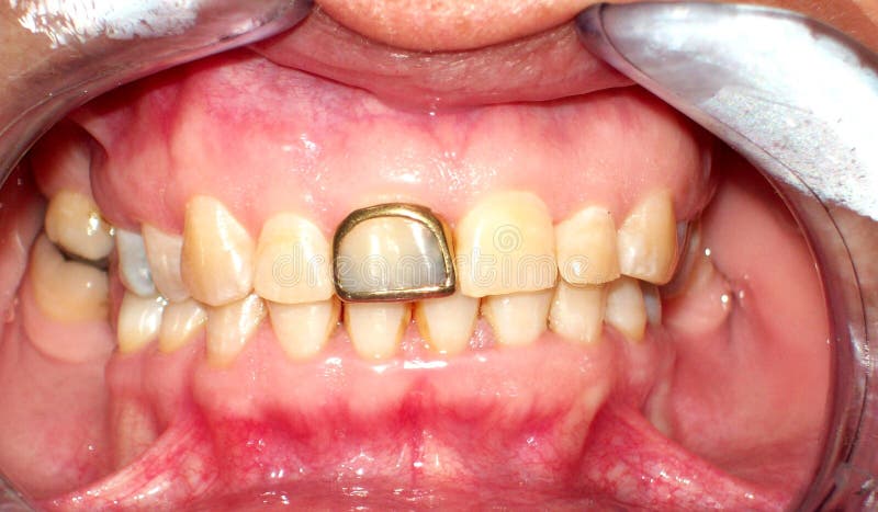 Incomplete Tooth Gold Crown Stock Image - Image of peruvian, incomplete ...
