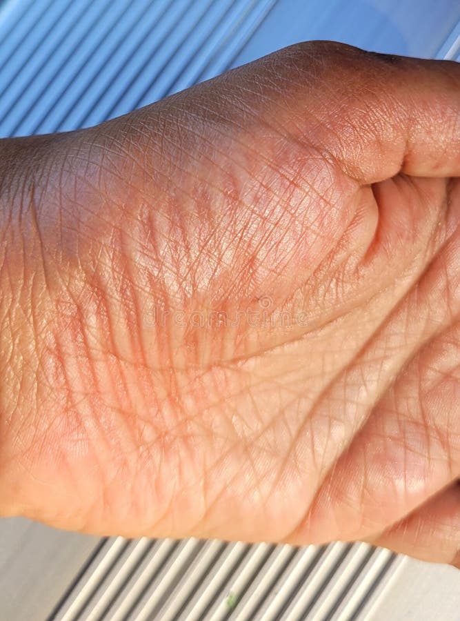 Indentation Made on Hand from a Metal Surface Stock Image - Image of ...