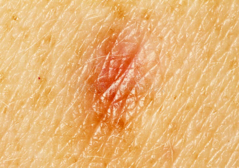 Indented Mole stock photo. Image of pigmented, dermatology - 23921926