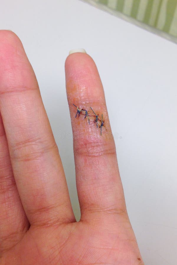 After Index Finger on Right Hand is Cut, Wound and Stitches Finger ...