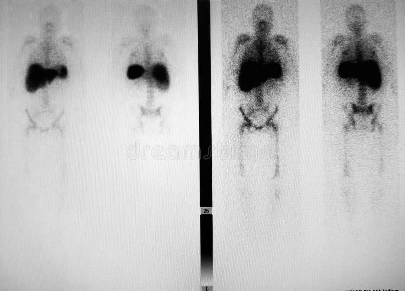 Indium Labeled WBC Scan - Normal Scan Images Stock Photo - Image of ...