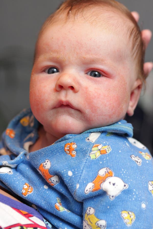 Eczema on face of newborn stock image. Image of childhood - 19674009