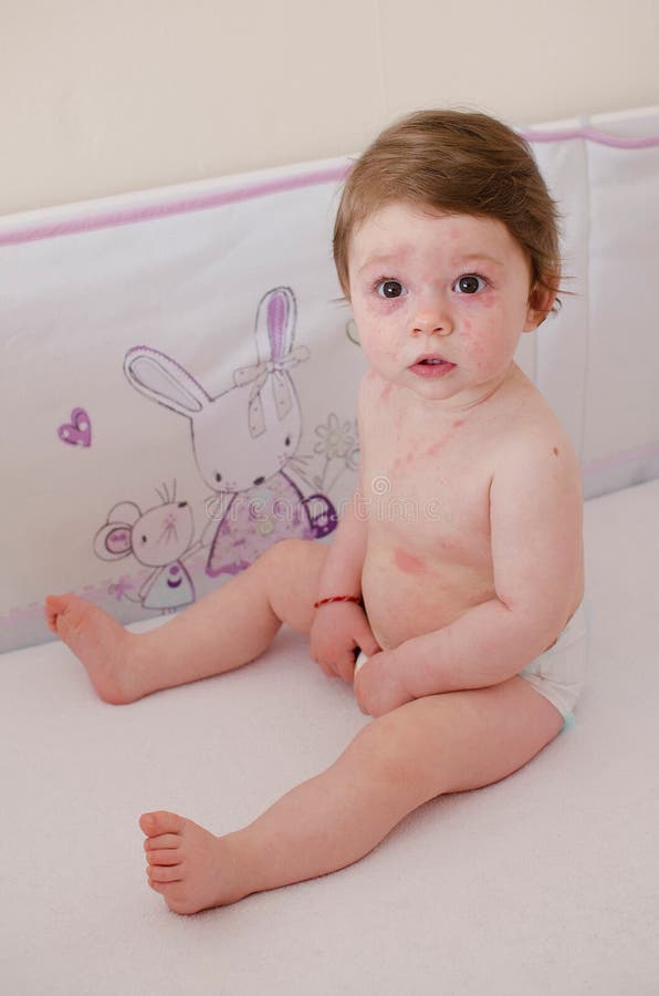 Infantum de Roseola foto de archivo. Imagen de virus - 76674128