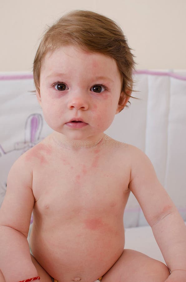 Infantum de Roseola imagen de archivo. Imagen de viral - 76674129