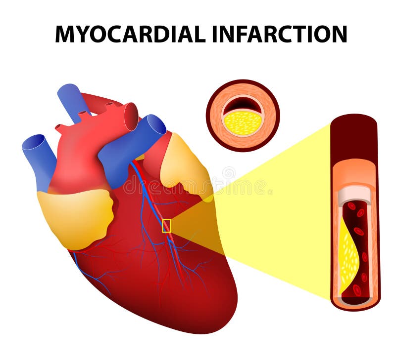 Infarctus du myocarde illustration de vecteur. Illustration du cellule ...
