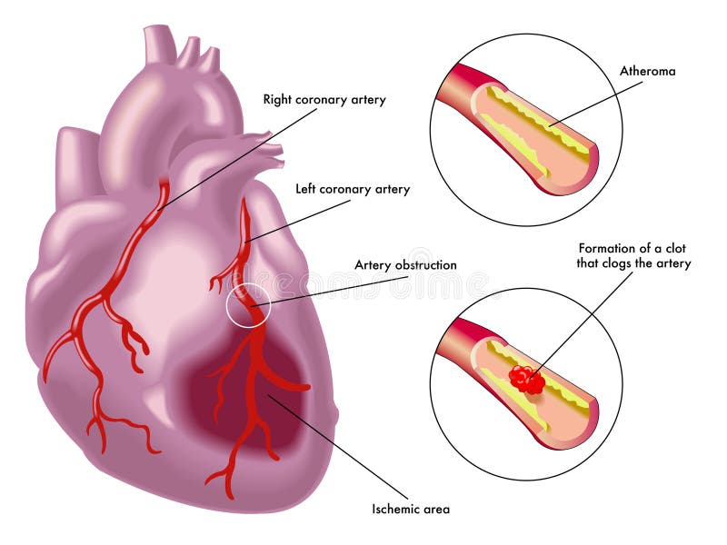 Infarto del miocardio ilustración del vector. Ilustración de agudo ...