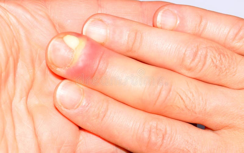 Infección de la mano foto de archivo. Imagen de absceso - 58387736