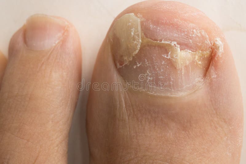 Infected Big Toe stock image. Image of therapy, nail - 265540465