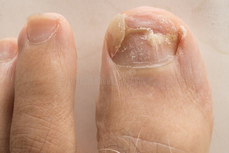 Infected Big Toe stock image. Image of pedicure, care - 265541125